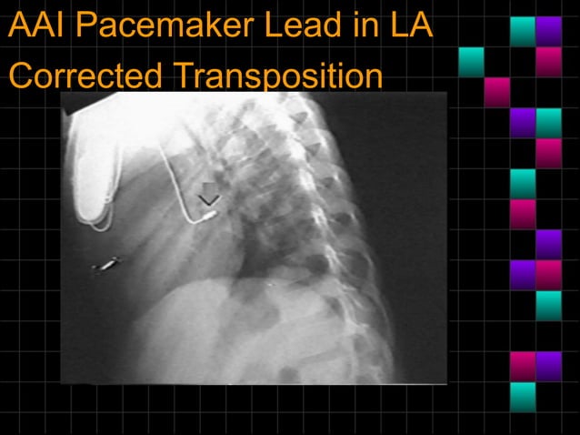 Pacemaker radiologyanintroduction | PPT
