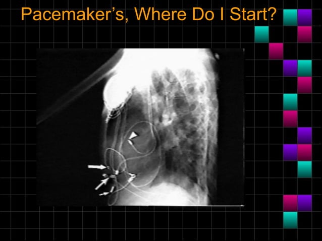 Pacemaker radiologyanintroduction | PPT