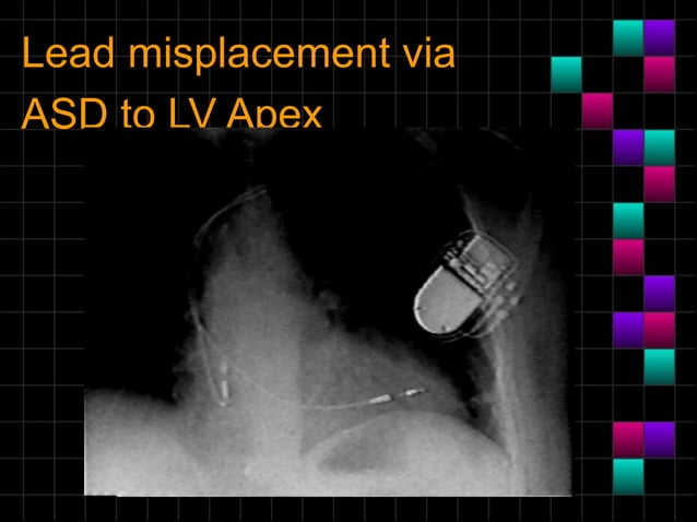 Pacemaker radiologyanintroduction | PPT