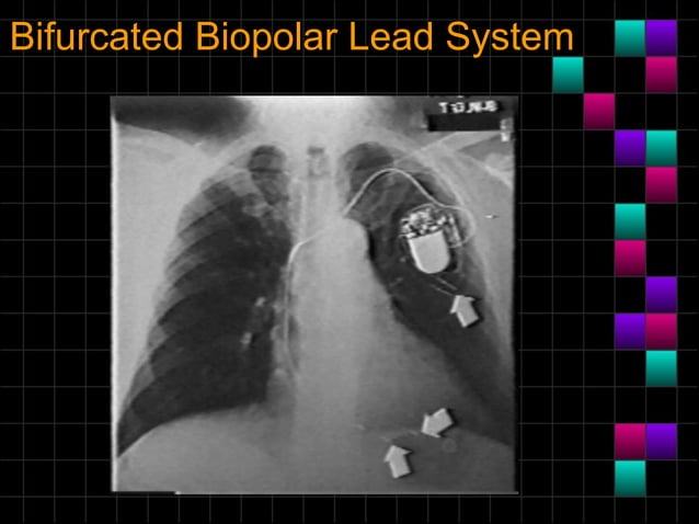Pacemaker radiologyanintroduction | PPT