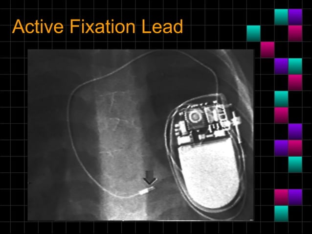 Pacemaker radiologyanintroduction | PPT
