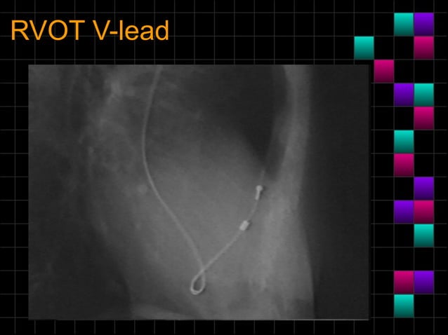 Pacemaker radiologyanintroduction | PPT