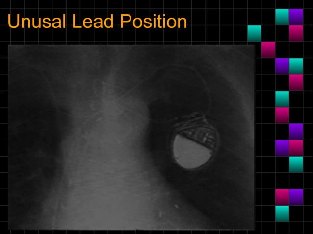 Pacemaker radiologyanintroduction | PPT