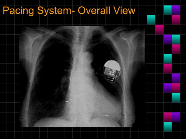 Pacemaker radiologyanintroduction | PPT