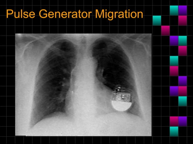 Pacemaker radiologyanintroduction | PPT