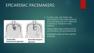 Pace makers | PPT