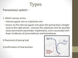 Cardiac Pacemakers | PPT