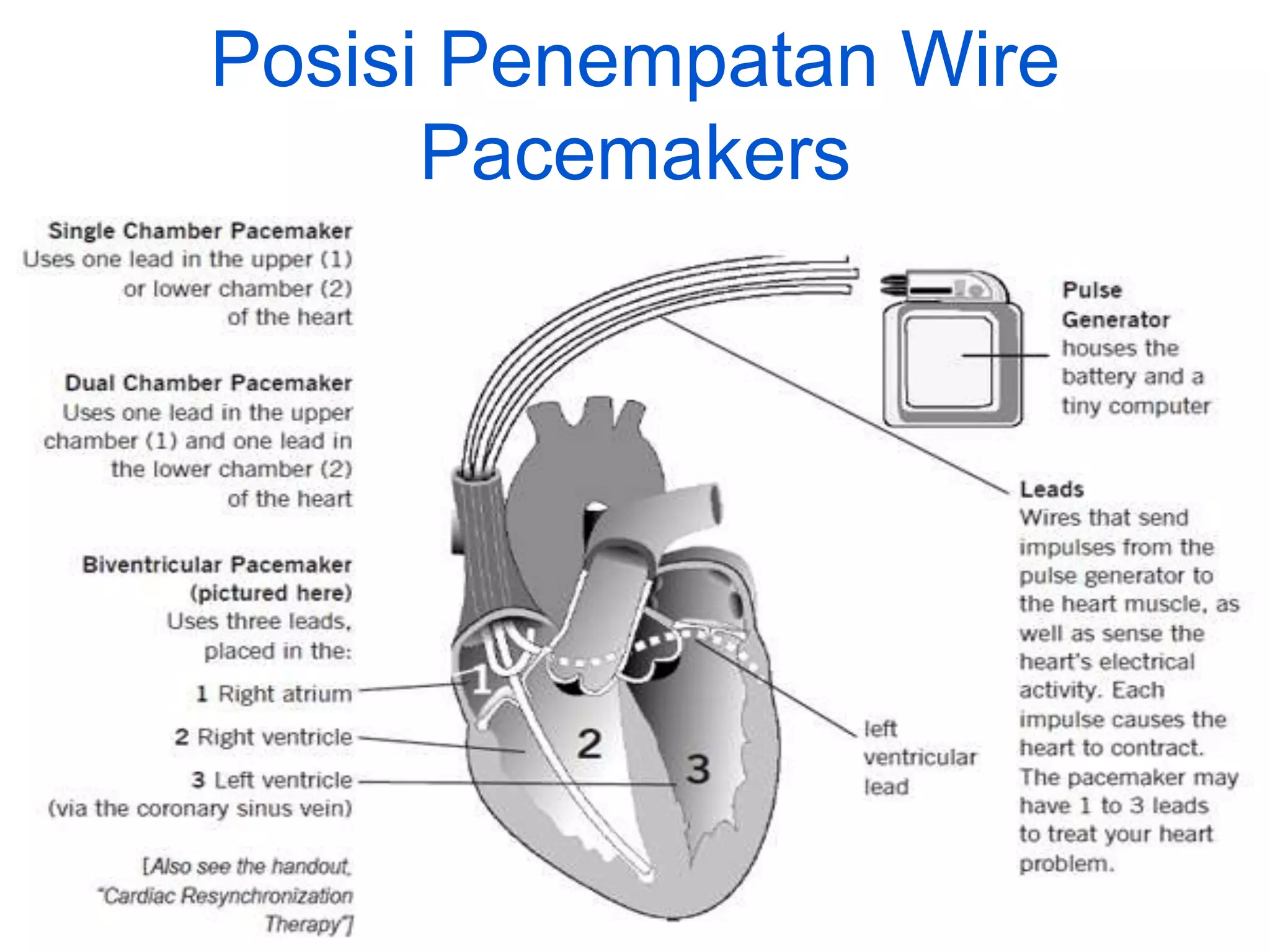 Penatalaksanaan dental Anak Dengan Gangguan Sistem Kardiovaskular *Pacemakers&Bakterial ...