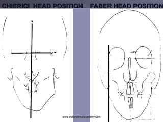 Postero - Anterior Chphalometry /cosmetic dentistry courses | PPT | Ear ...