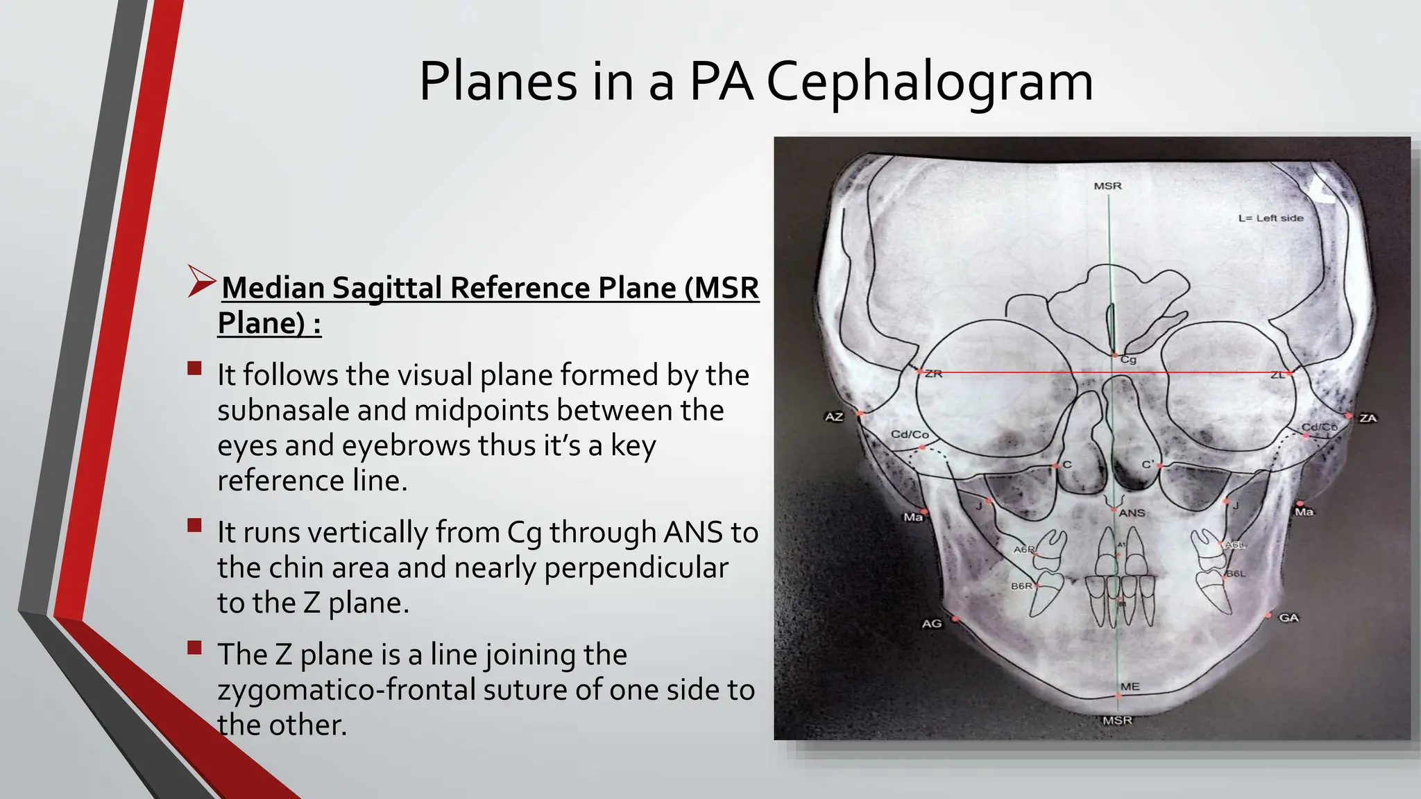 Posteroanterior Cephalometrics in orthodontics.pptx