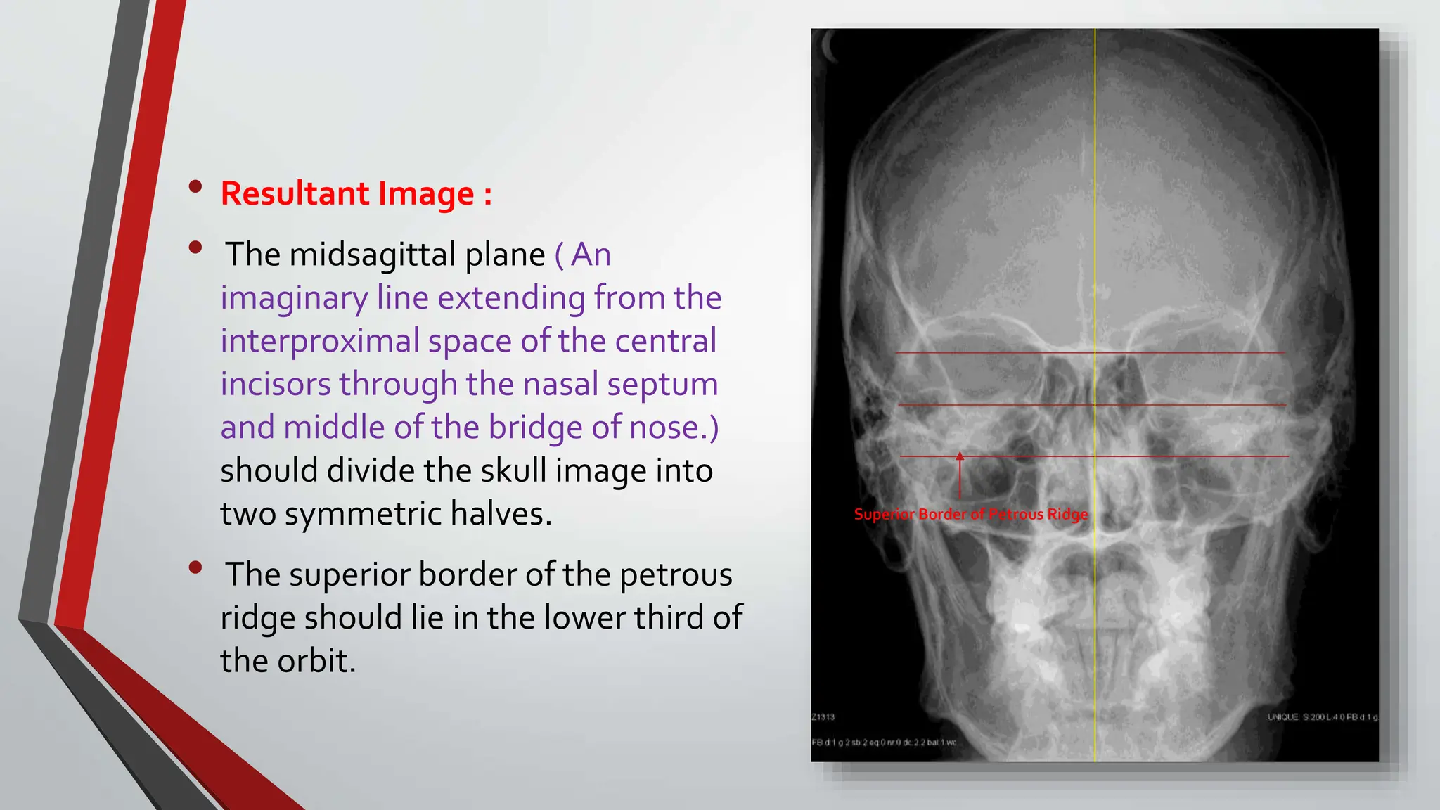 Posteroanterior Cephalometrics in orthodontics.pptx