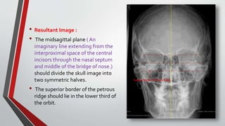 Posteroanterior Cephalometrics in orthodontics.pptx