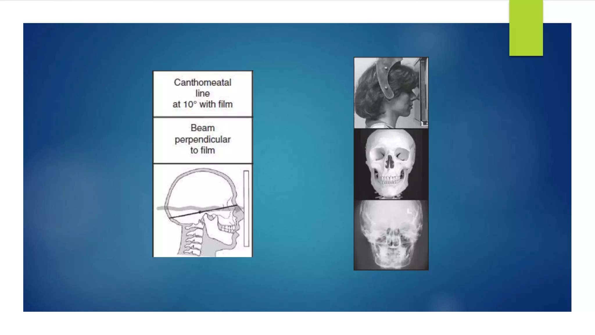 Pa(posteroanterior) cephalometry | PPTX