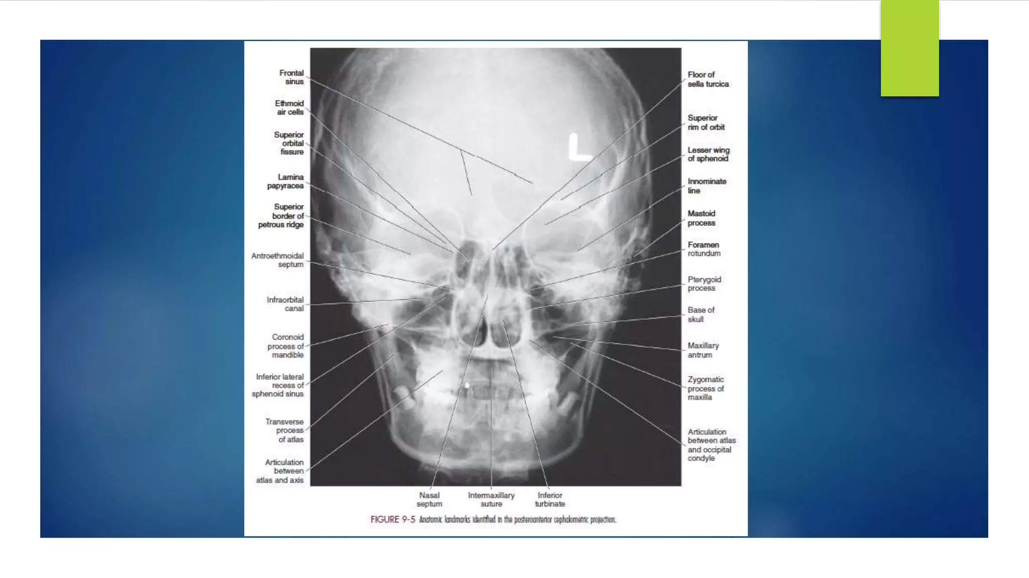 Pa(posteroanterior) cephalometry | PPTX