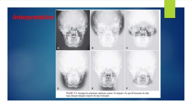 Pa(posteroanterior) cephalometry | PPTX | Ear, Nose and Throat ...