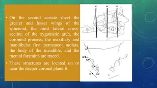 Lesser Wing Of Sphenoid Ceph