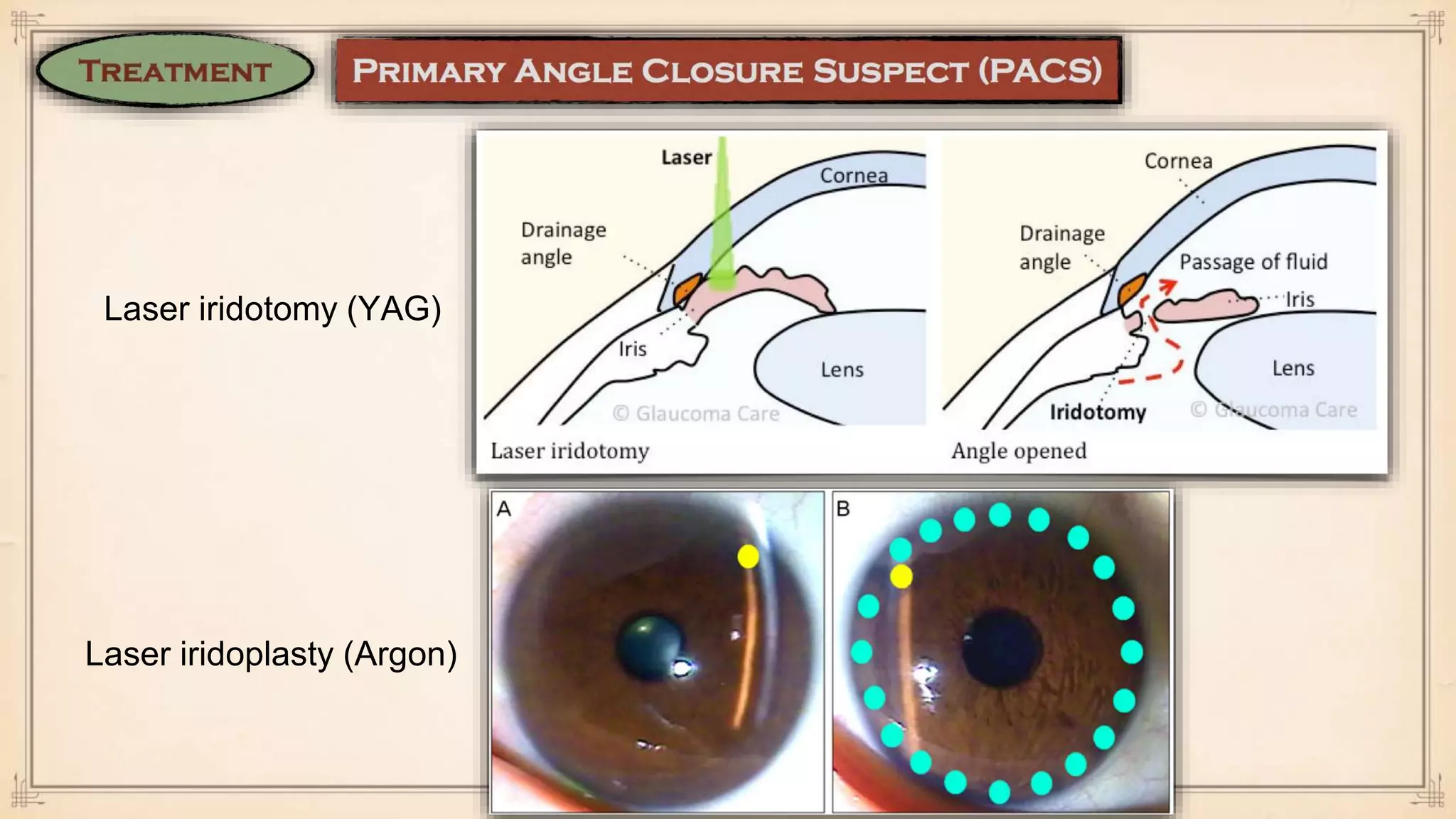 Primary Angle Closure Glaucoma | PPT | Free Download