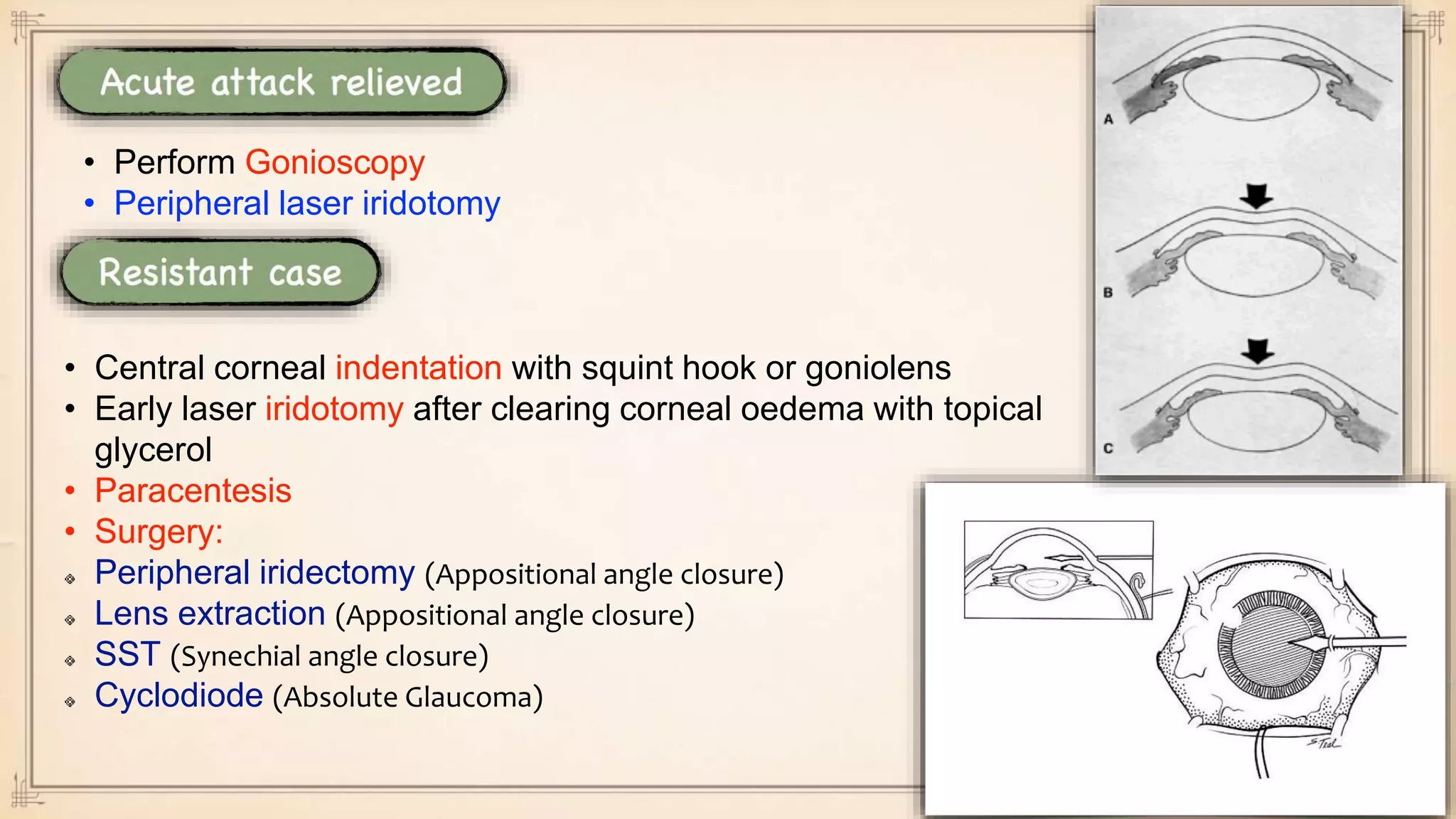 Primary Angle Closure Glaucoma | PPTX