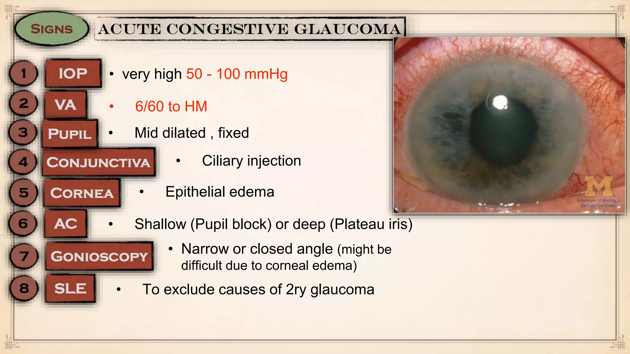 Primary Angle Closure Glaucoma | PPTX