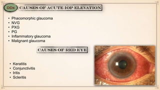 Primary Angle Closure Glaucoma | PPTX