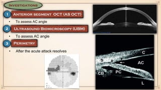 Primary Angle Closure Glaucoma | PPTX