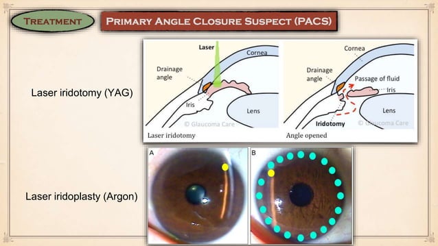 Primary Angle Closure Glaucoma | PPT