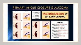 Primary Angle Closure Glaucoma | PPTX