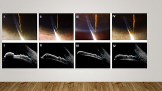 Primary Angle Closure Glaucoma | PPTX