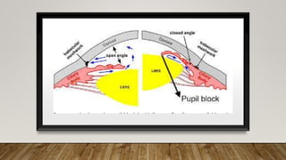 Primary Angle Closure Glaucoma | PPTX
