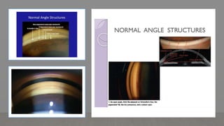 Primary Angle Closure Glaucoma | PPTX