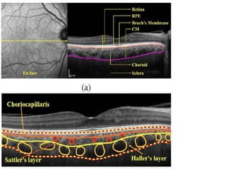 Pachychoroid | PPTX