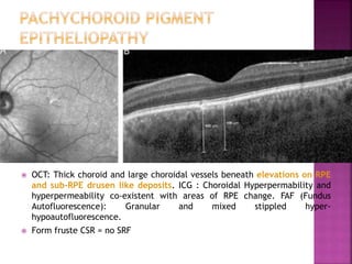 Pachychoroid | PPTX