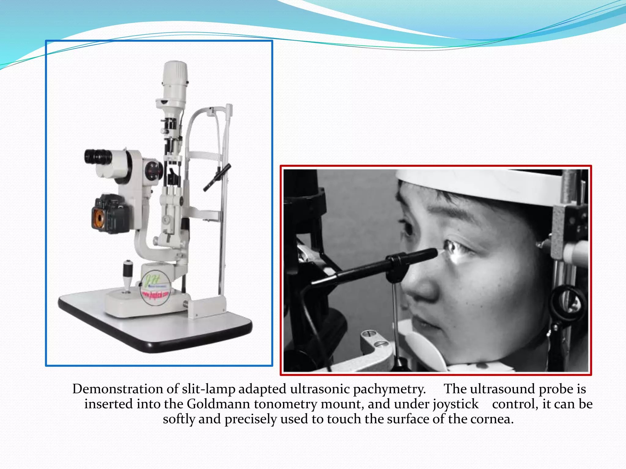 corneal Pachymetry | PPTX