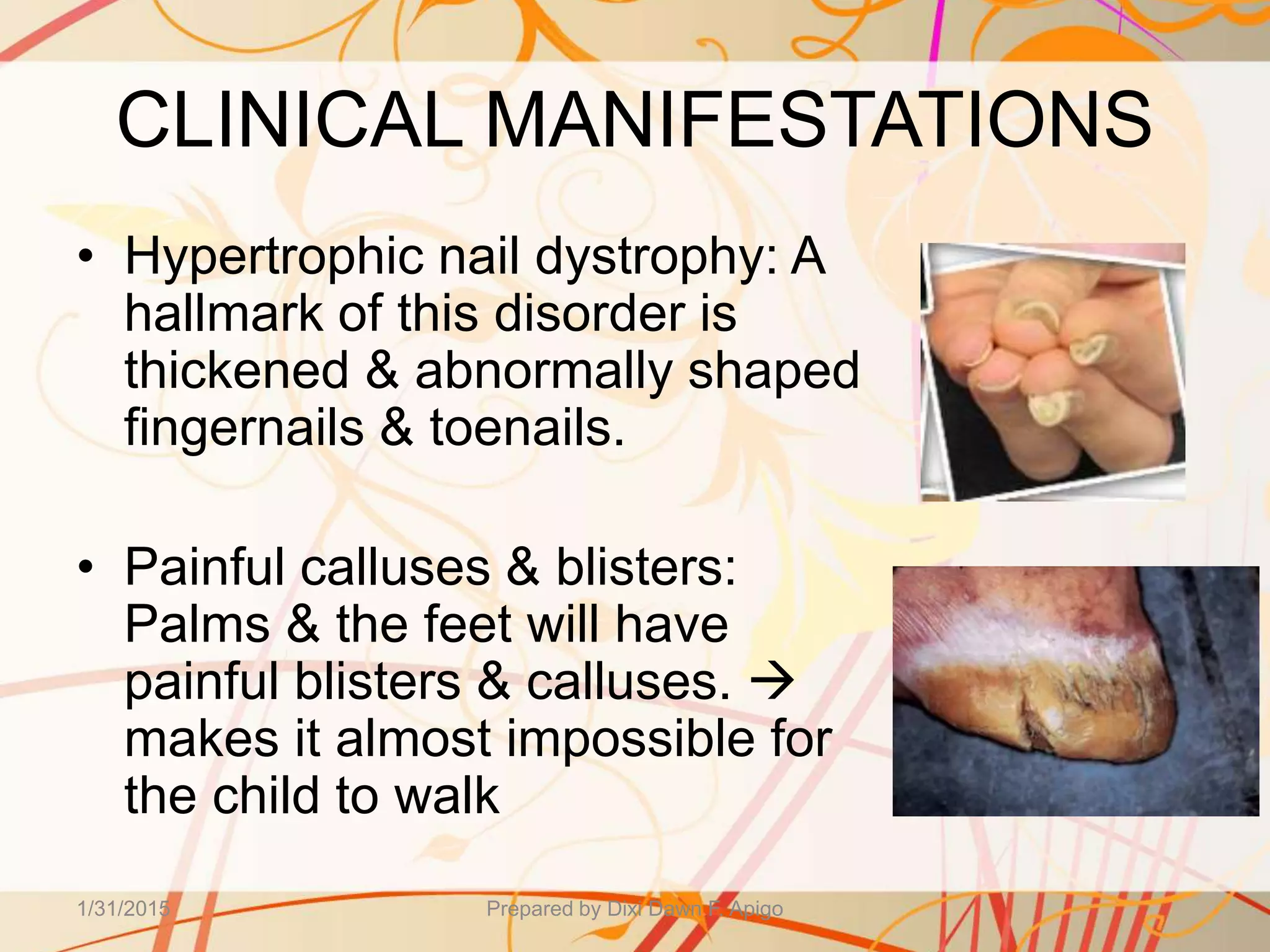 Pachyonychia congenita | PPTX