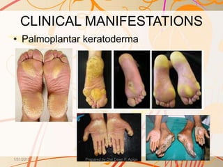 Pachyonychia congenita | PPTX