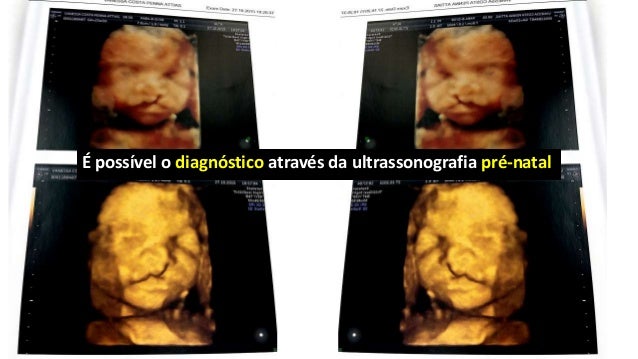 FISSURAS LABIAIS E LABIOPALATINAS