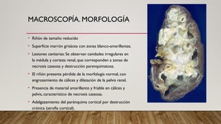 Paciente verosimil Pielonefritis tuberculosa.pptx