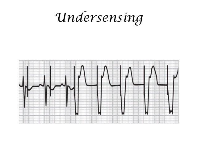 Pacing by Hussam Tayeb - SMACC ECG Workshop 2014