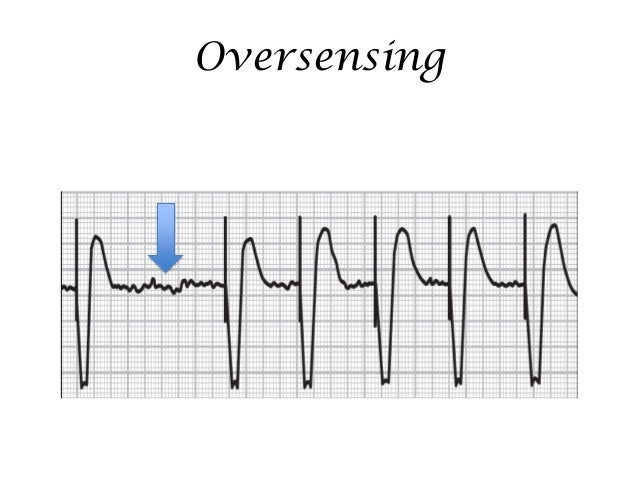 Pacing by Hussam Tayeb - SMACC ECG Workshop 2014