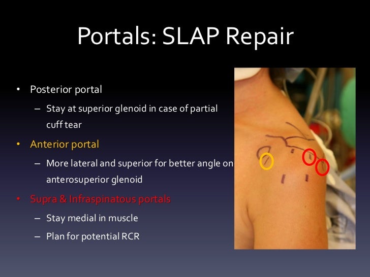 What Is A Shoulder Slap Repair at Michael Gates blog