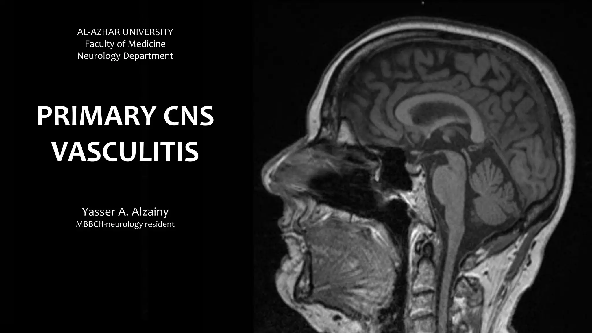 Primary CNS vasculitis | PPT