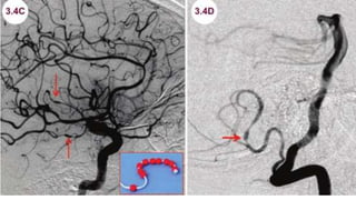 Primary CNS vasculitis | PPT