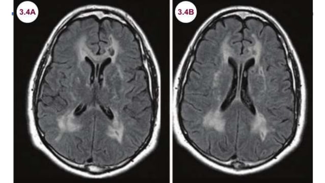 Primary Cns Vasculitis Ppt
