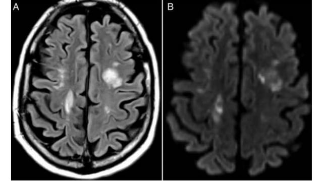 Primary CNS vasculitis | PPT