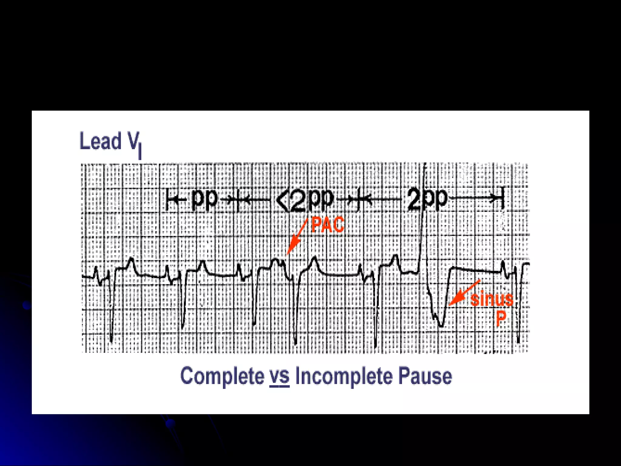 Premature Atrial complexes | PPT