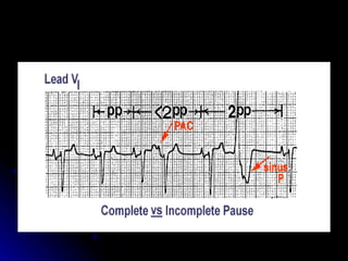 Premature Atrial complexes | PPT