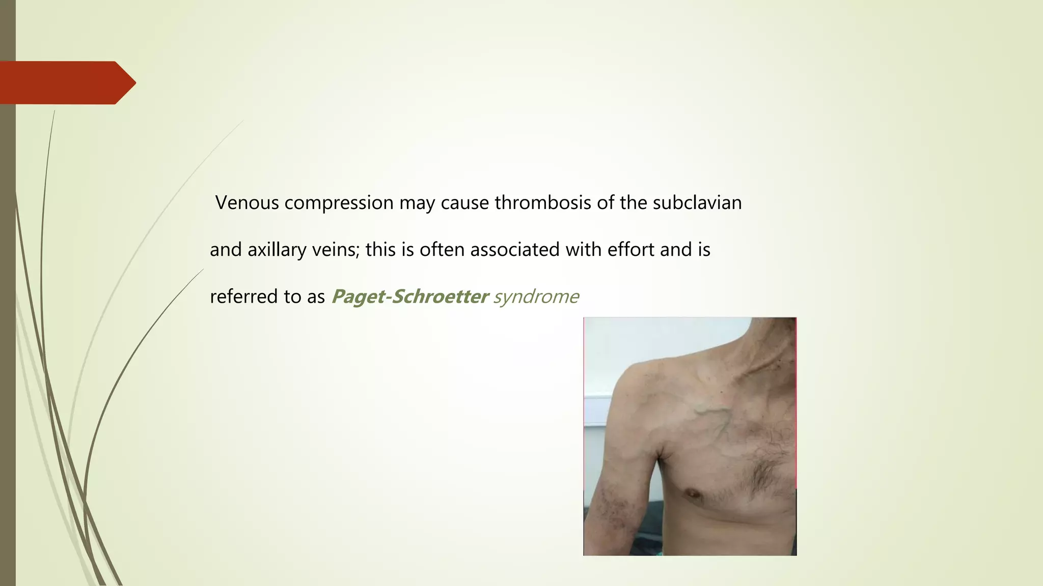 Peripheral artery disease | PPTX