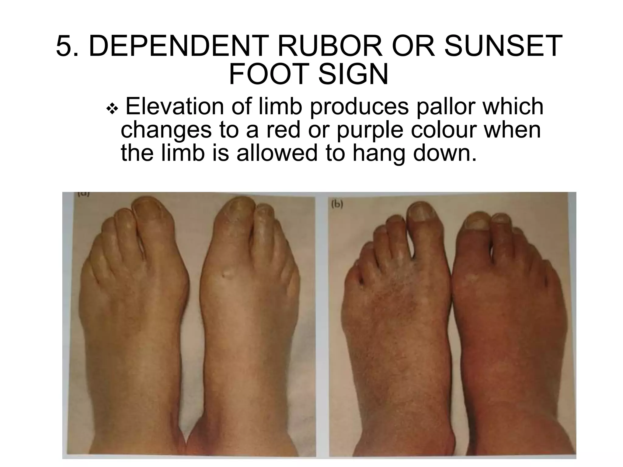 Peripheral artery disease | PPTX