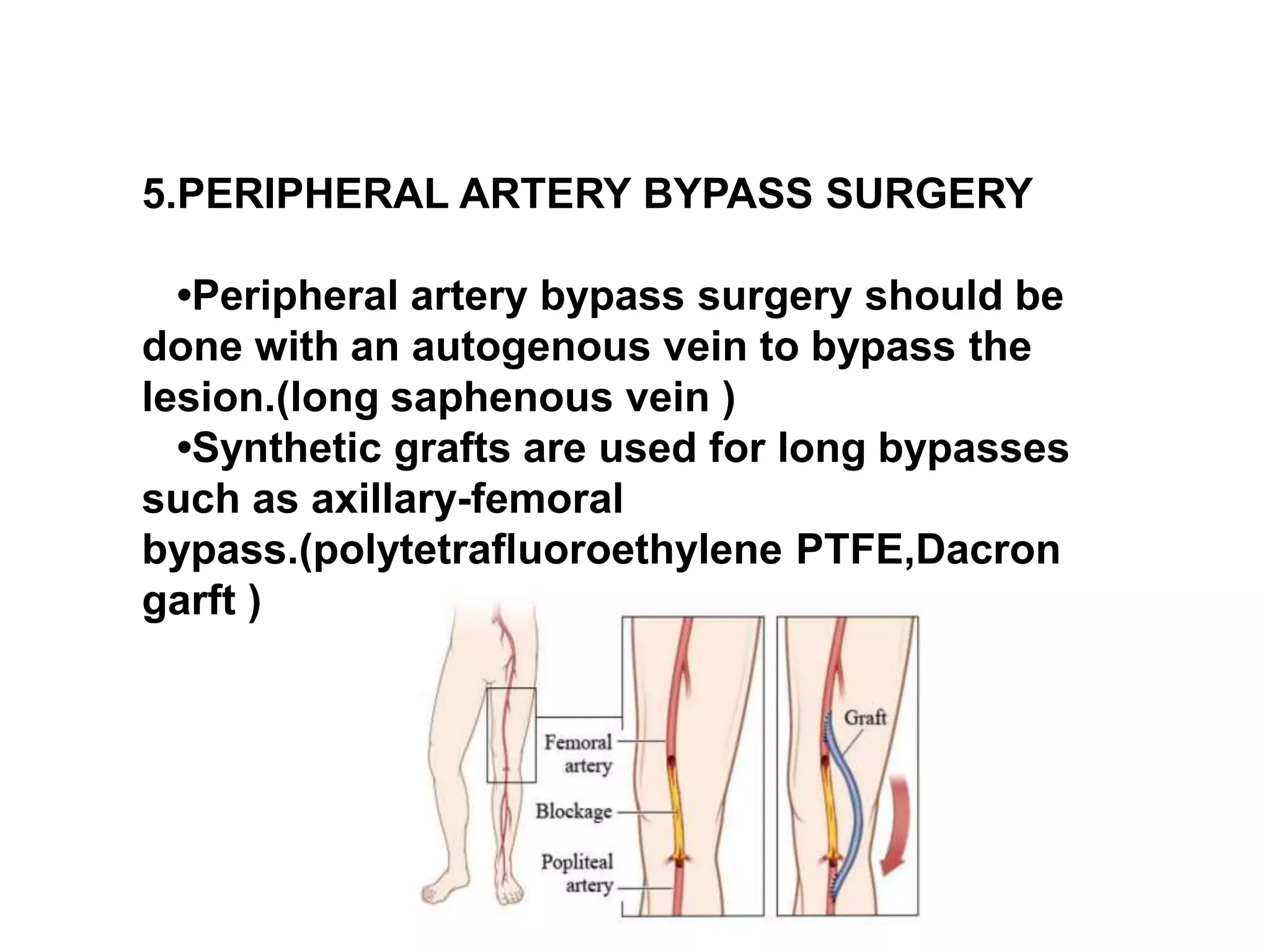 Peripheral artery disease | PPTX