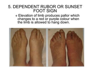 Peripheral artery disease | PPTX